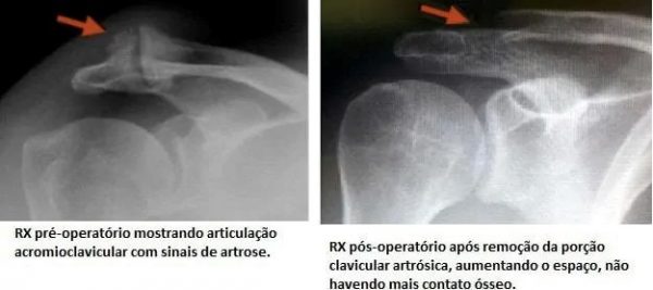 Artrose Acromio Clavicular - Dr. Guilherme Franco Dr. Guilherme Franco ...